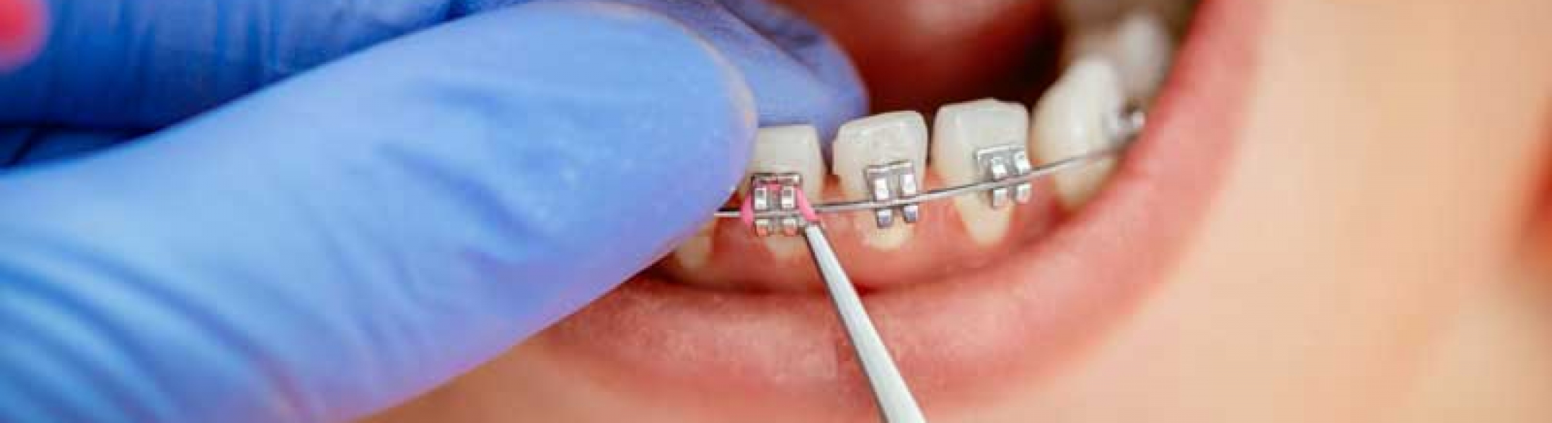 Phase 1 Orthodontics: What Is It and Why Is It Important | Garn & Mason